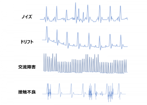 生体モニター機器設計の勘所 生体アンプにおけるAC結合の必要性｜inrevium